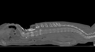 Airo TruCT | Stryker